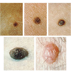 Lunares comunes, nevos displásicos y el riesgo de melanoma - National ...