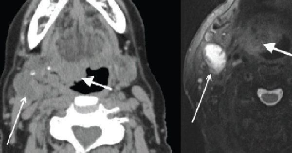 Oral HPV16 Infection Precedes Head and Neck Cancer - National Cancer ...