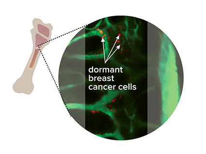 Less-Frequent Zoledronic Acid in Patients with Bone Metastases ...