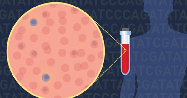 Circulating Multiple Myeloma Tumor Cells - National Cancer Institute