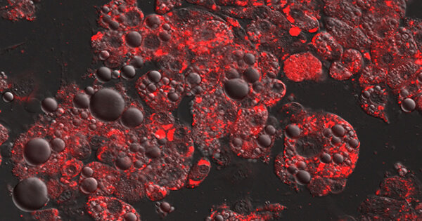 Fat Cells May Hinder Chemotherapy Effectiveness - National Cancer Institute