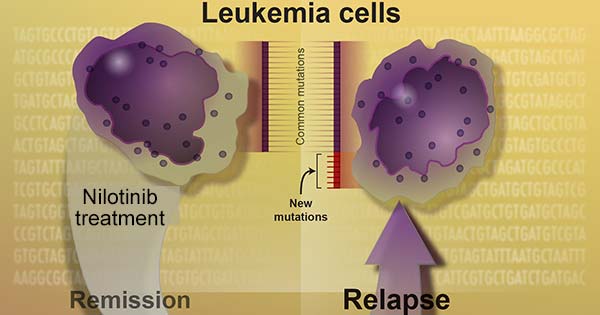 Discontinuing Nilotinib in Patients with CML - National Cancer Institute