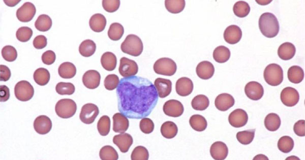 Tagraxofusp Effective for BPDCN - National Cancer Institute