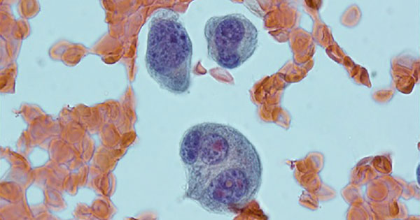 Slowing the Progression of Smoldering Myeloma - National Cancer Institute