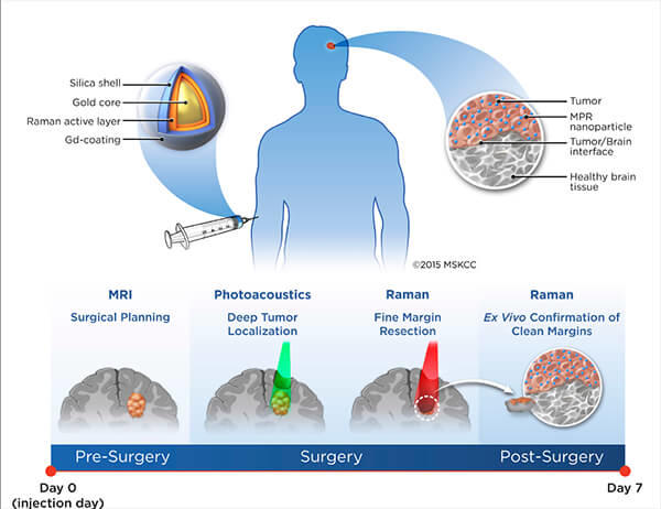 Nanotechnology and Early Cancer Detection and Diagnosis - NCI Nanotechnology and Early Cancer Detection and Diagnosis - NCI