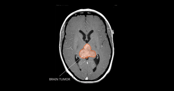 Atypical Teratoid Rhabdoid Tumors (ATRT) - National Cancer Institute