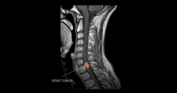 Ependymoma - National Cancer Institute