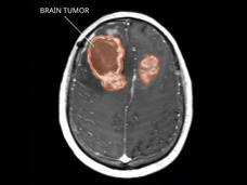 Rare Brain and Spine Tumors - NCI