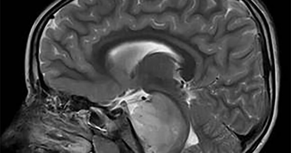 Dipg Symptome / DIPG Angels 2 - YouTube / The role of biopsy in dipg ...