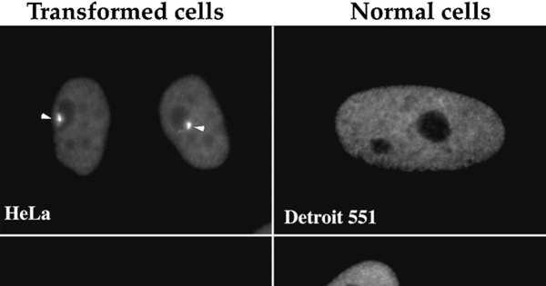 Experimental Drug Metarrestin Targets Metastatic Tumors - NCI