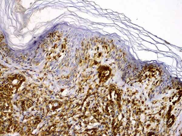 Brentuximab Approved for Two Rare Lymphomas - National Cancer Institute