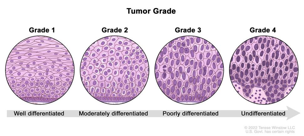 Grado del tumor - NCI