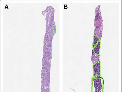 The Human Tumor Atlas Network Creates New Cancer Maps - National Cancer ...