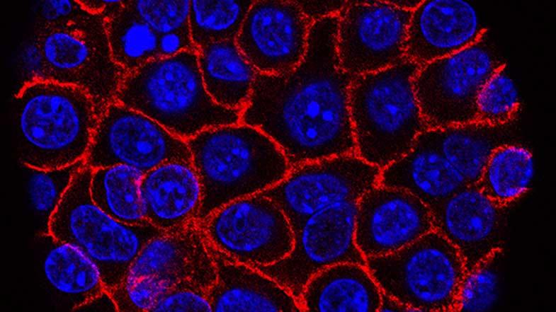 Pancreatic Cancer—Patient Version - National Cancer Institute