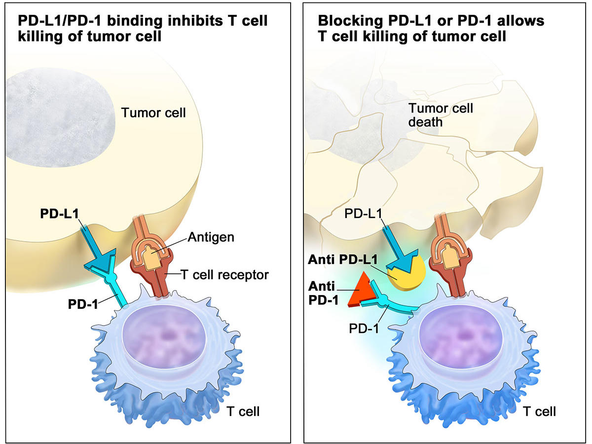 Atezolizumab for Bladder Cancer - NCI