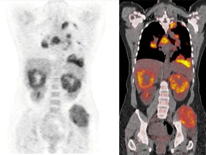 Immunotherapy Combination Approved for Advanced Kidney Cancer - NCI