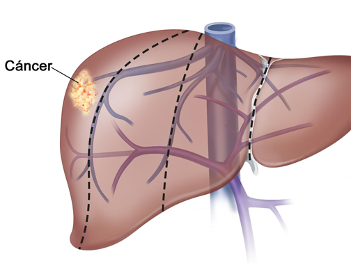 Menos quimioterapia para algunos niños con cáncer de hígado