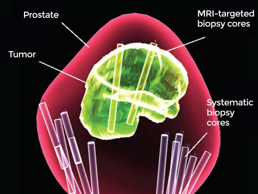 Combined biopsy method improves prostate cancer diagnosis - NCI