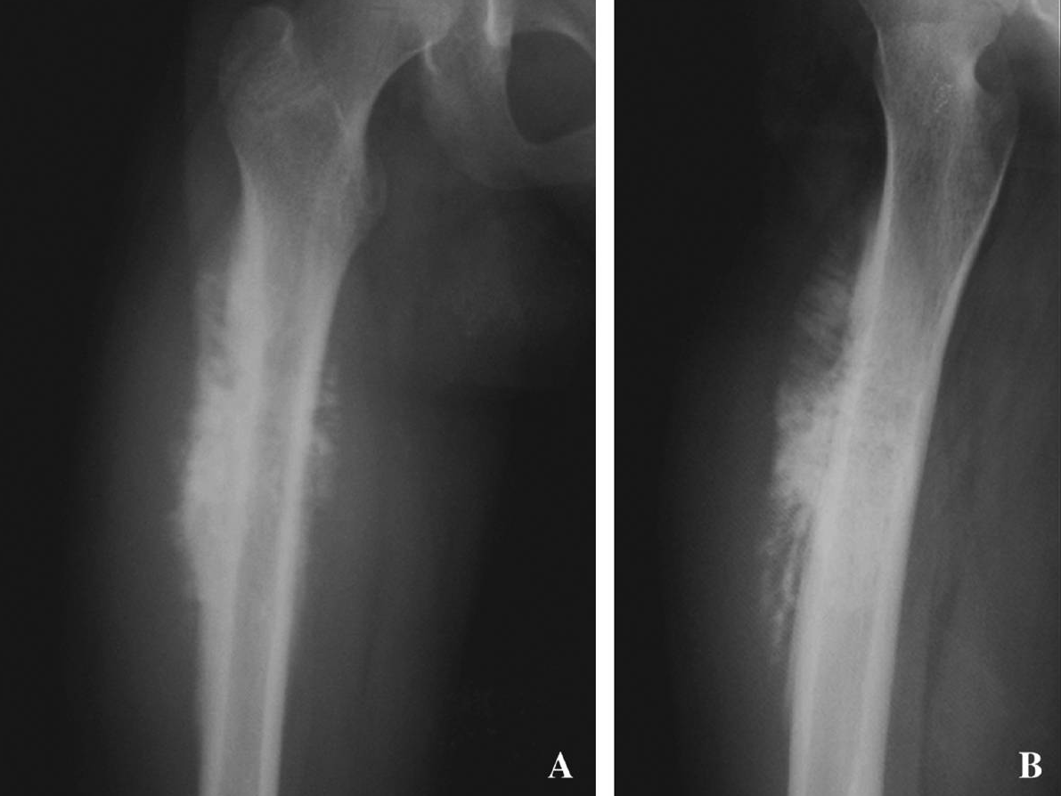 Osteosarcoma