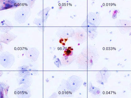 AI approach improves cervical cancer screening in NCI study - NCI
