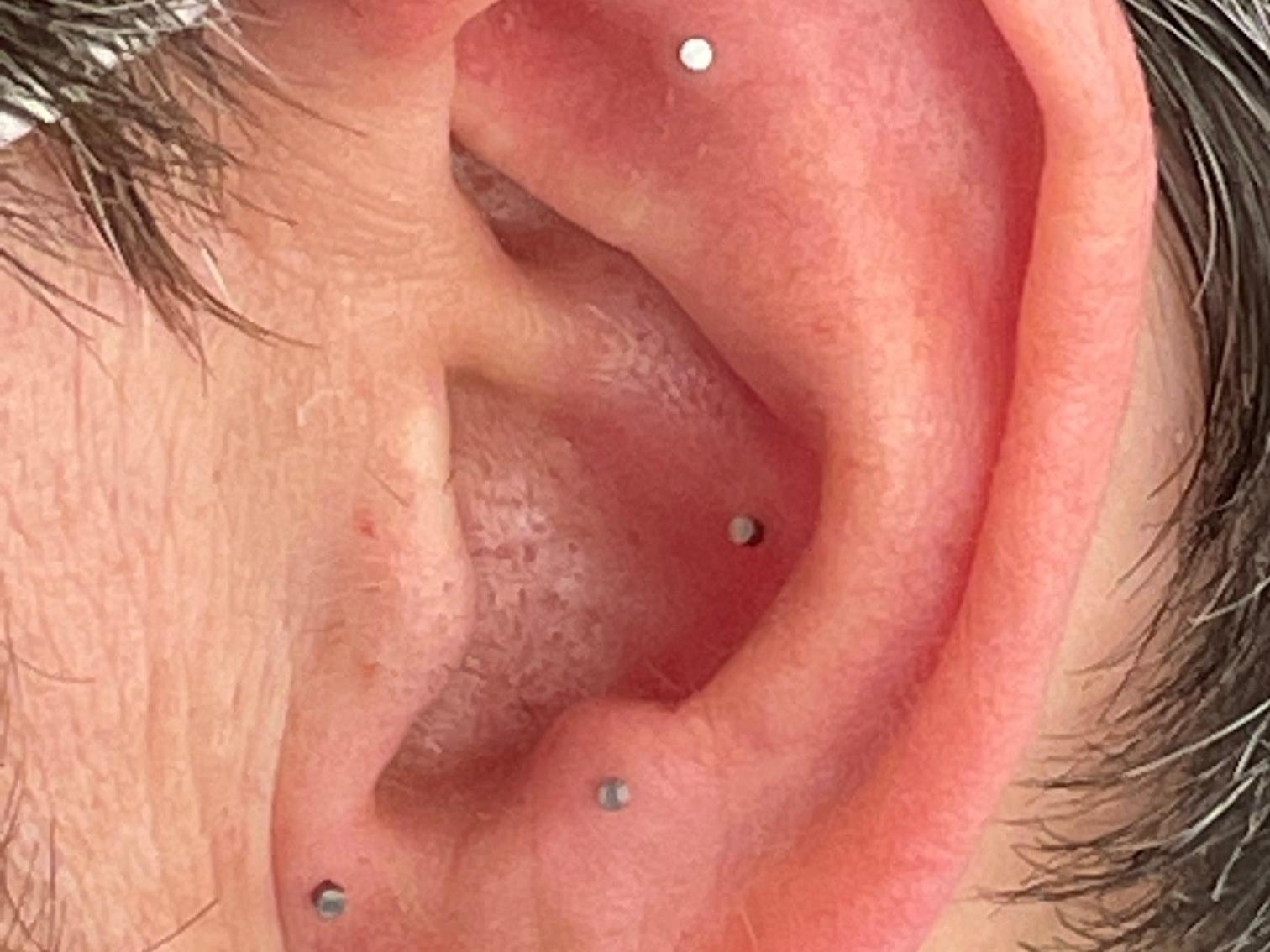 Can Acupuncture Help Cancer Survivors with Chronic Pain? - NCI