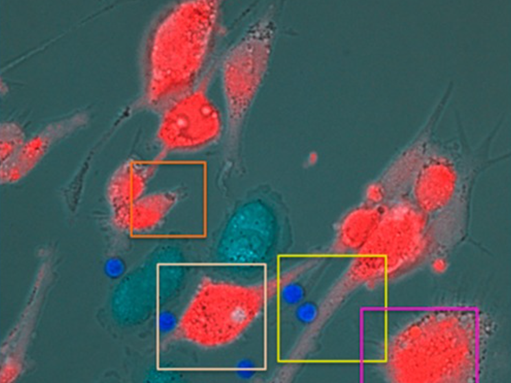 El tebentafusp prolonga la supervivencia de los pacientes con melanoma ...