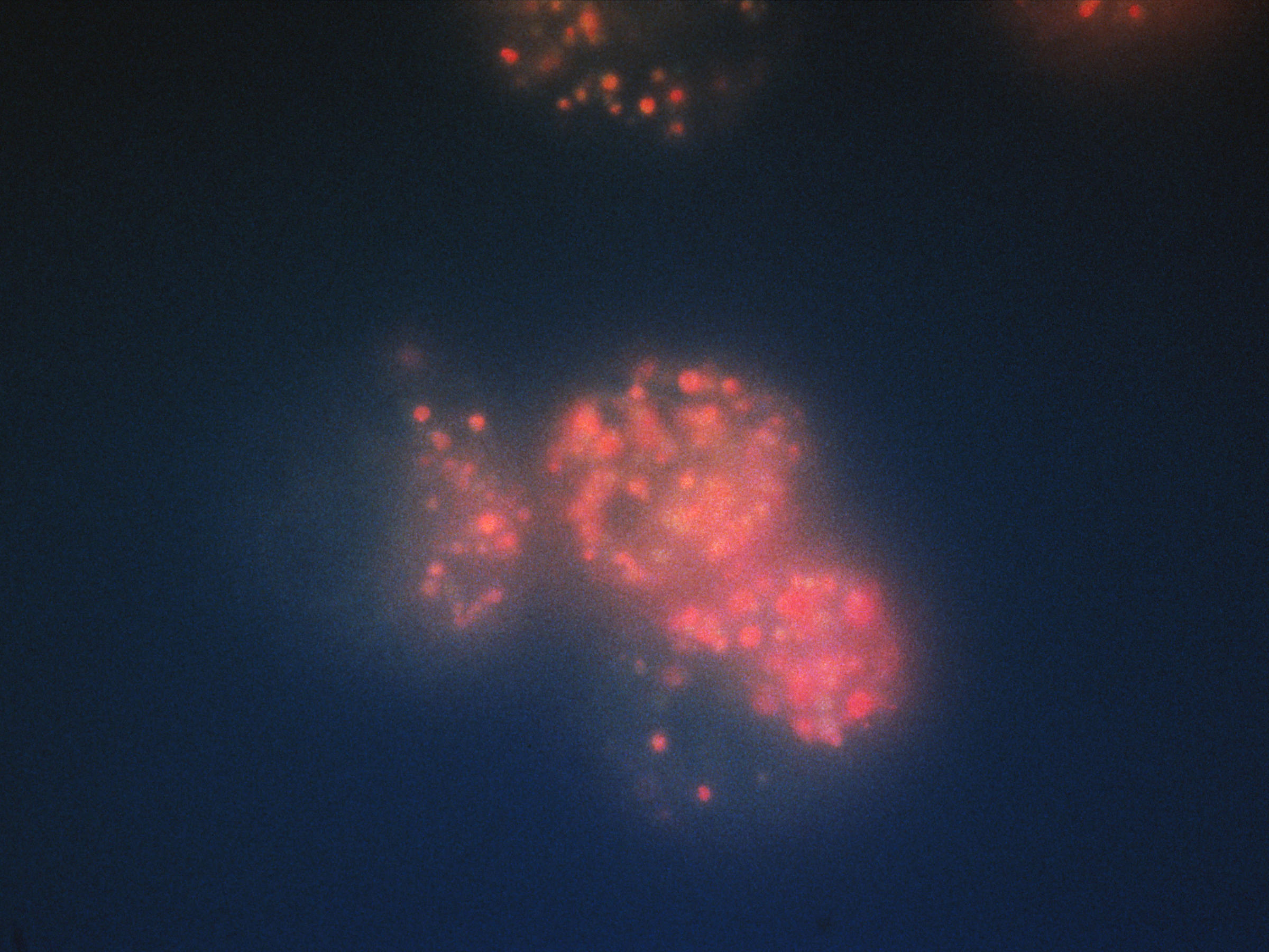 Photodynamic Therapy to Treat Cancer - NCI