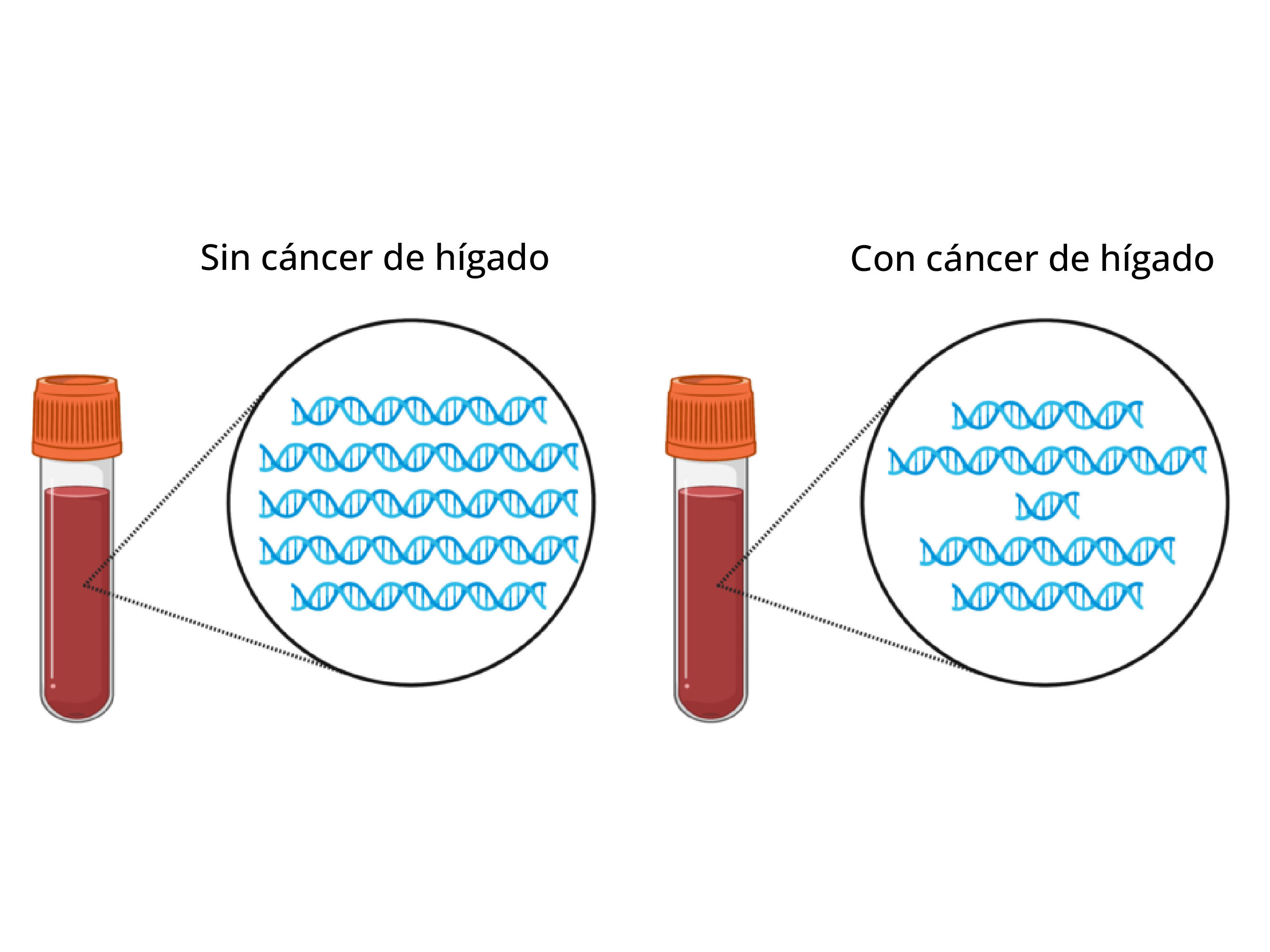 Una prueba de sangre detecta el cáncer de hígado mediante fragmentómica