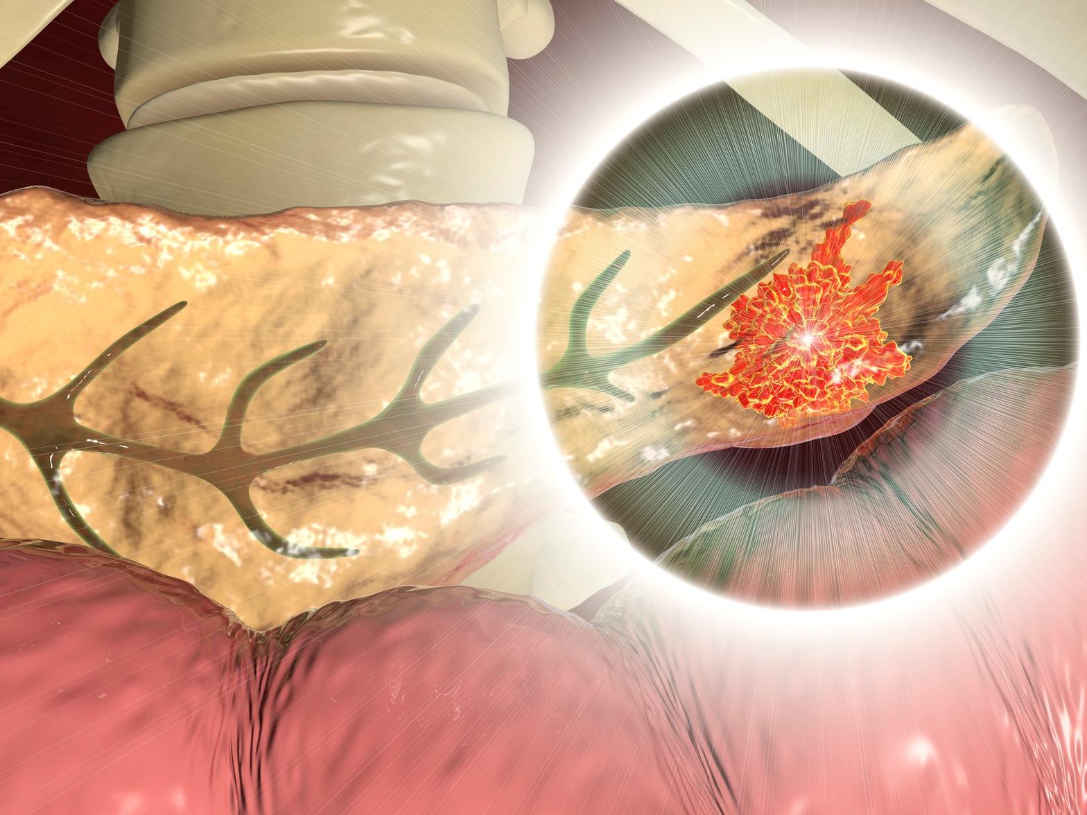 Pancreatic Cancer Finds Alternate Fuel for Survival, Growth - NCI