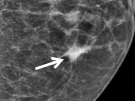 Mammogram False Positives Affect Future Screening Behavior - NCI