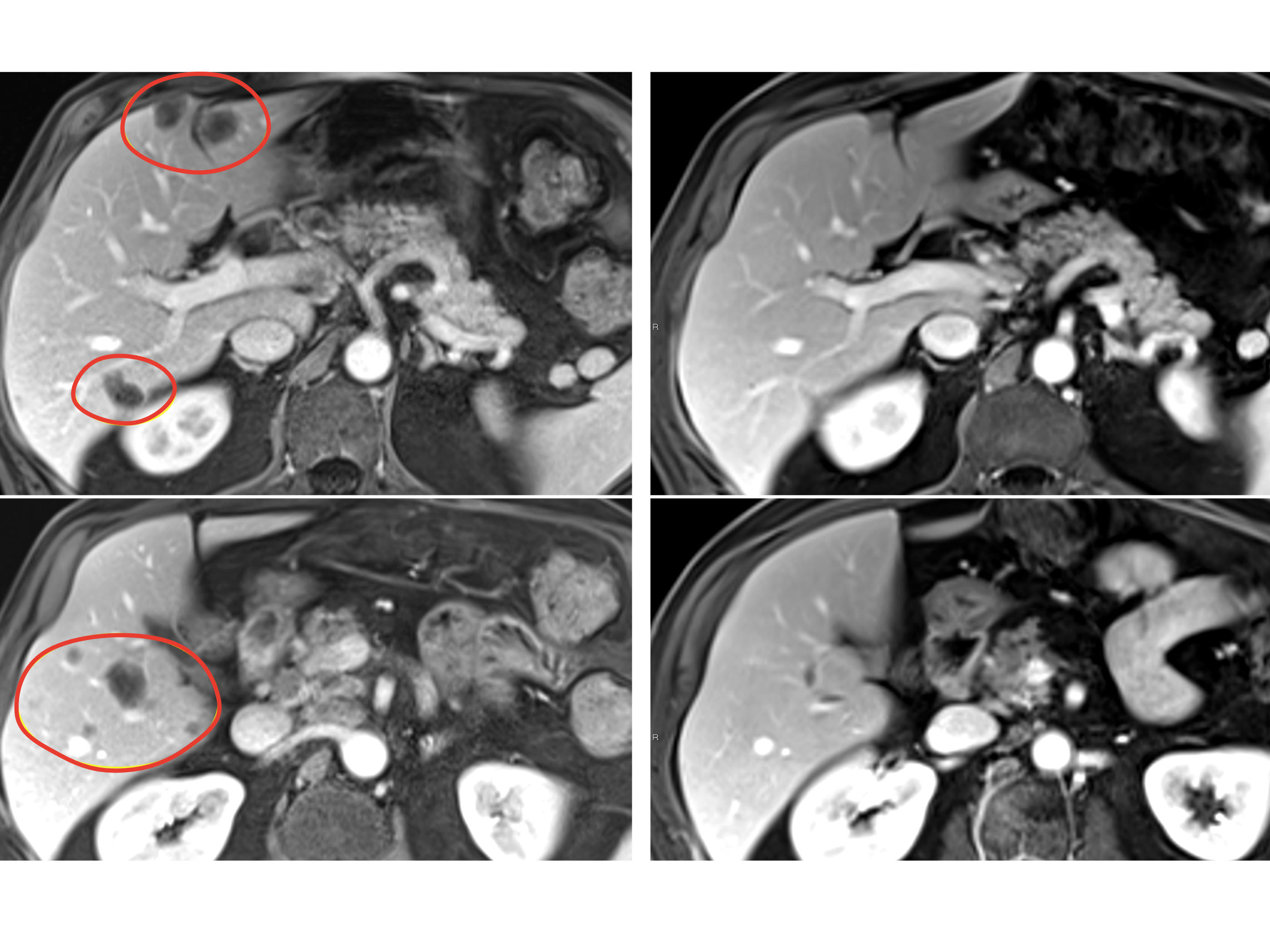 TIL therapy for metastatic gastrointestinal cancers - NCI