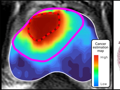 Using Artificial Intelligence to Map Prostate Tumors - NCI