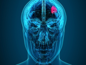 The Human Tumor Atlas Network (HTAN): Exploring Tumor Evolution in Time ...